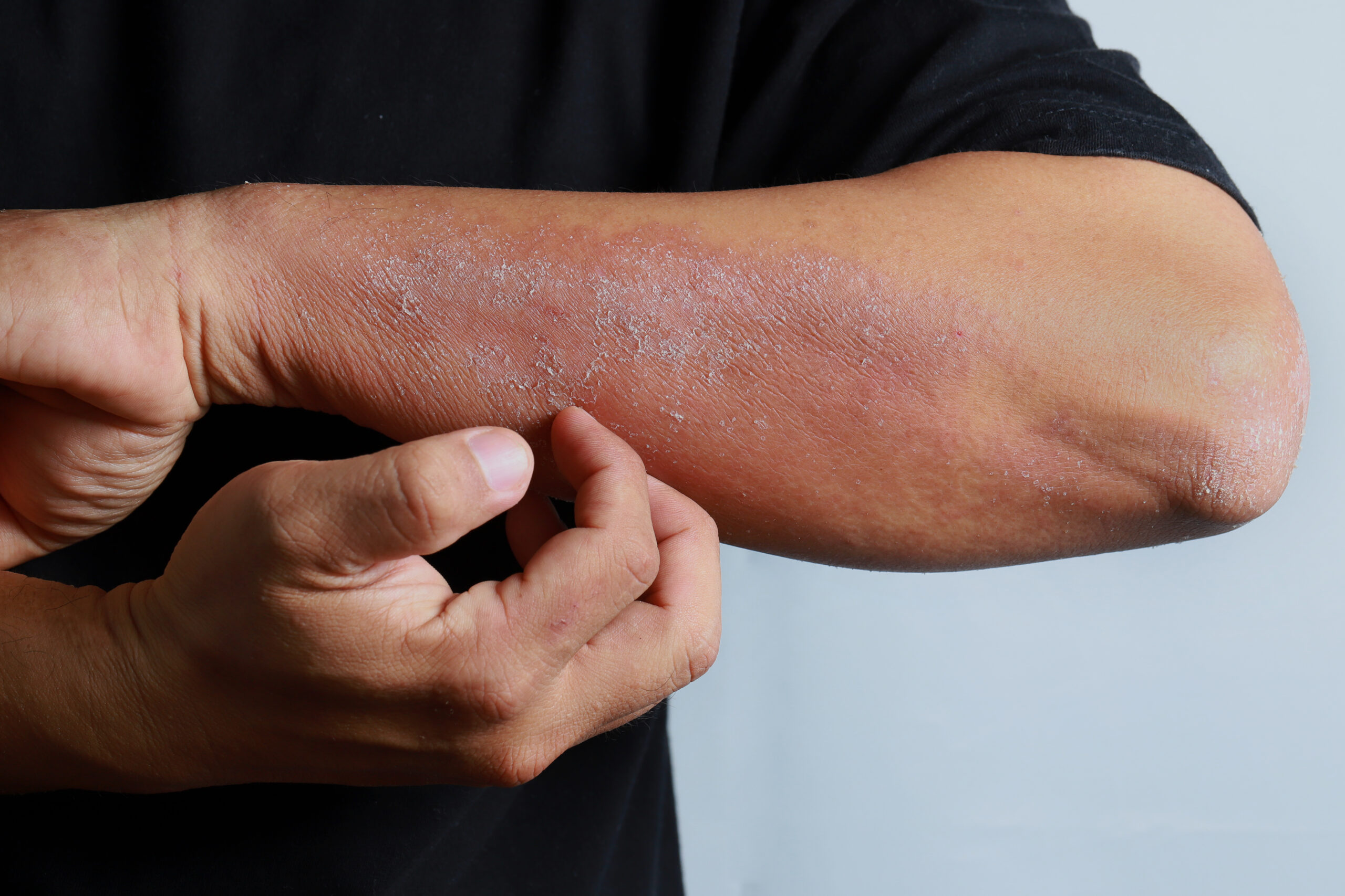 Psoriasis Is MORE Than a Skin Condition – Healthy Truth
